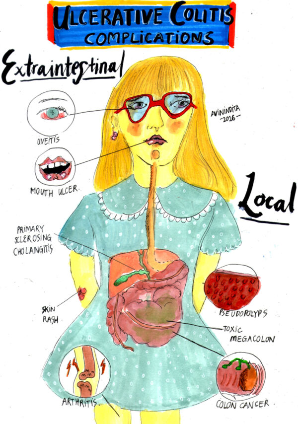 Inflammatory Bowel Disease | Armando Hasudungan