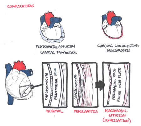 Percarditis | Armando Hasudungan
