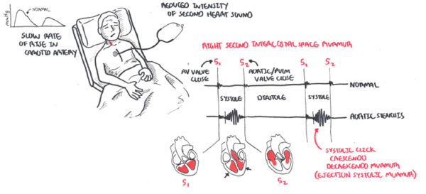 Aortic Stenosis - Armando Hasudungan
