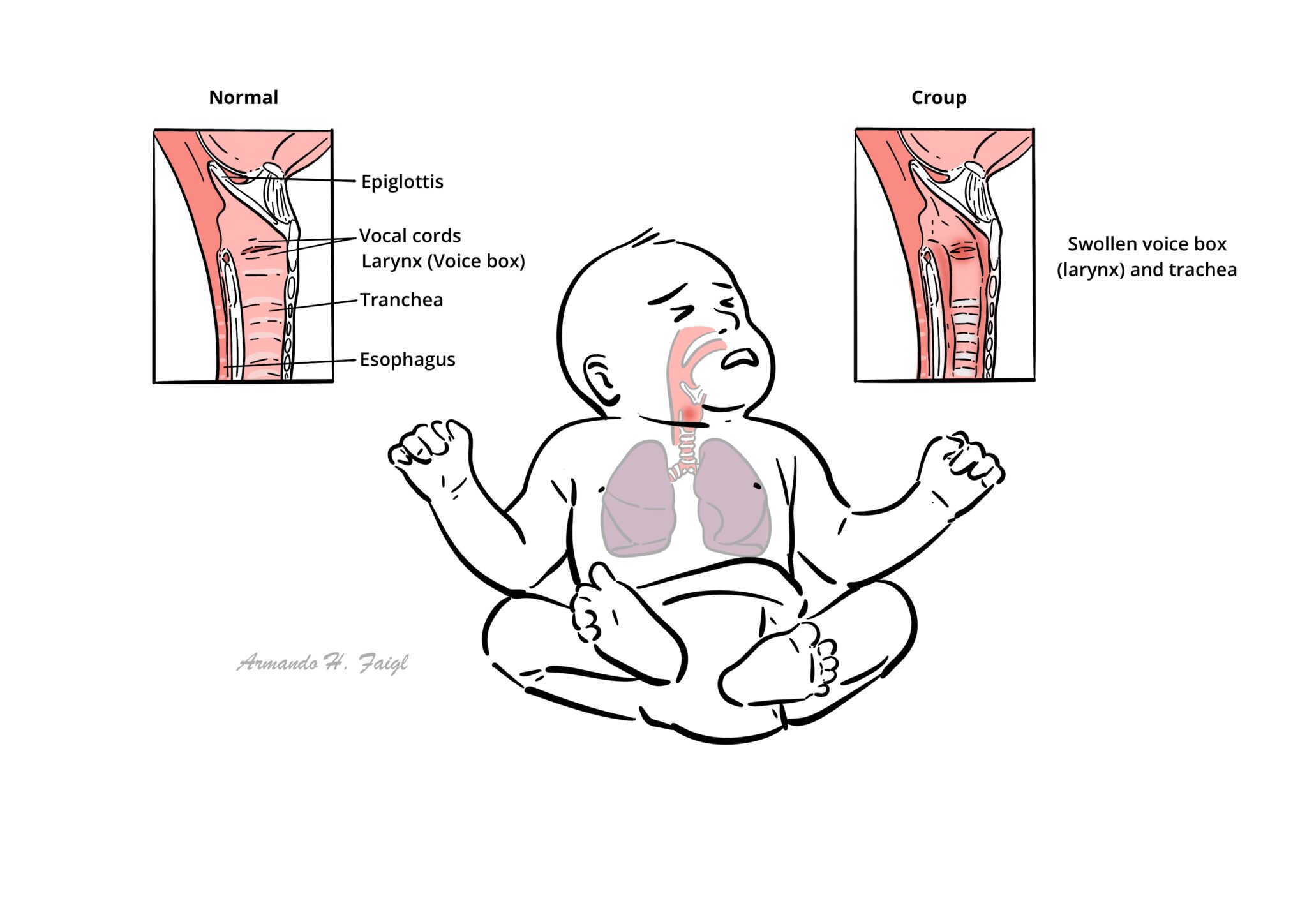Croup Armando Hasudungan