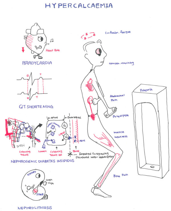 Hypercalcaemia Armando Hasudungan