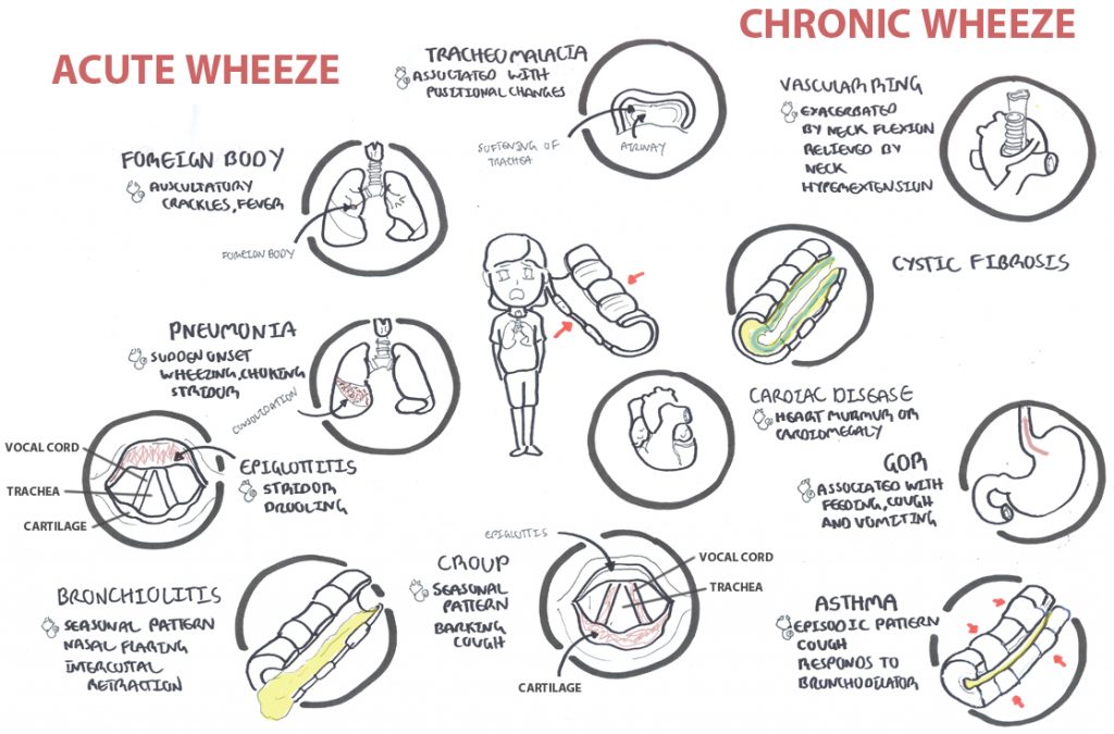 Wheeze Armando Hasudungan