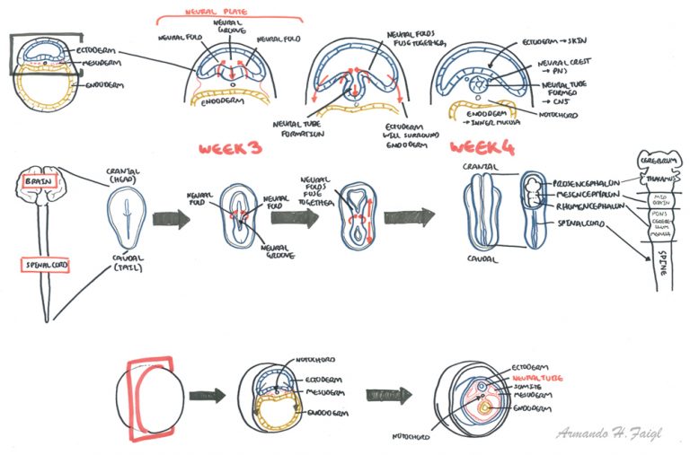Neural Tube Defect - Armando Hasudungan