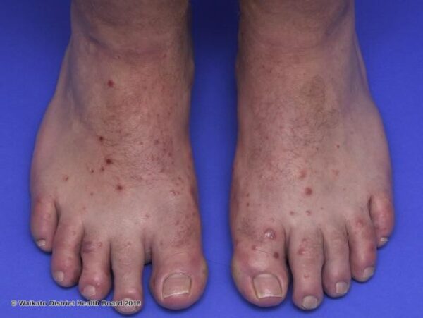 Paediatric Viral Cutaneous Infection Armando Hasudungan