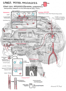 ANCA Associated Vasculitis - Personal Use - Armando Hasudungan