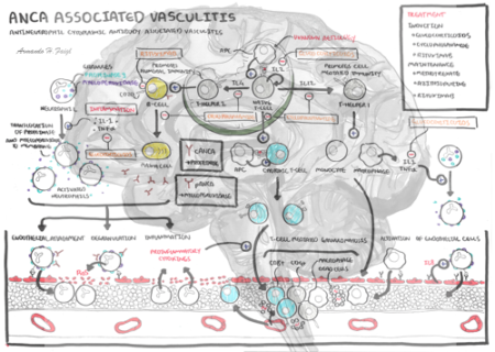 ANCA associated vasculitis Armando Hasudungan