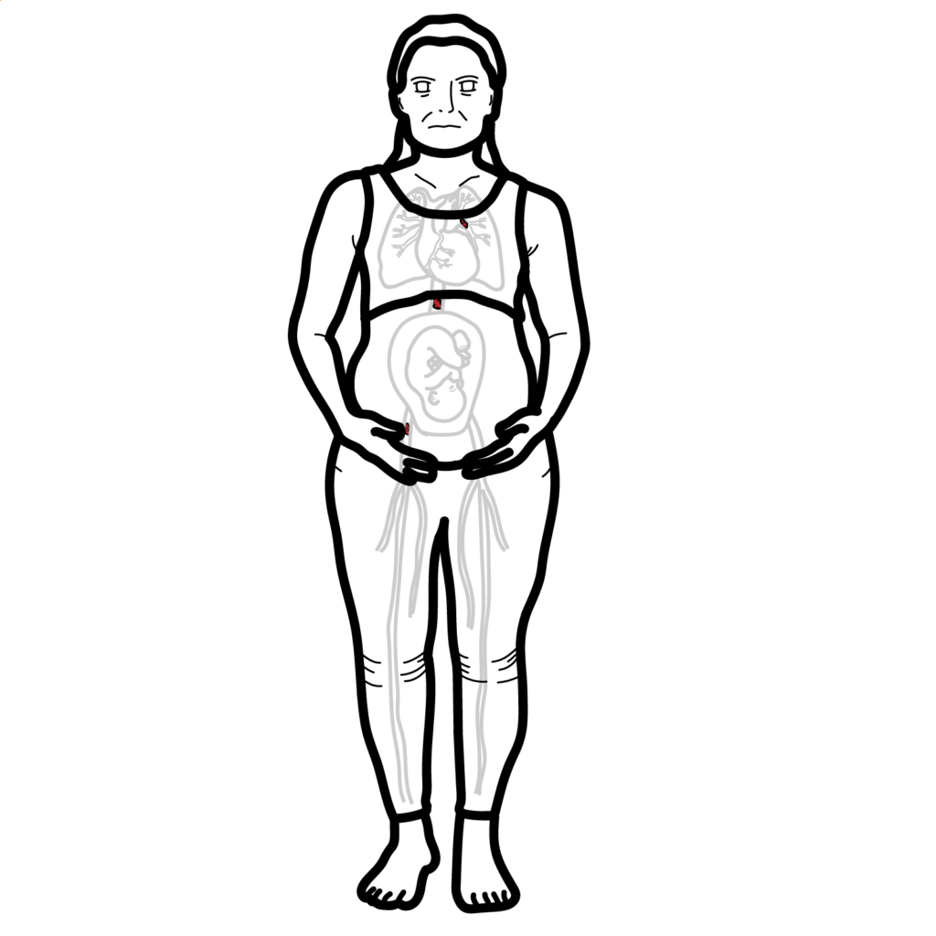 Undifferentiated Connective Tissue Disease (UCTD) - Armando Hasudungan