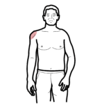 Basic Calcium Phosphate Disease / Milwaukee Shoulder Syndrome Armando ...