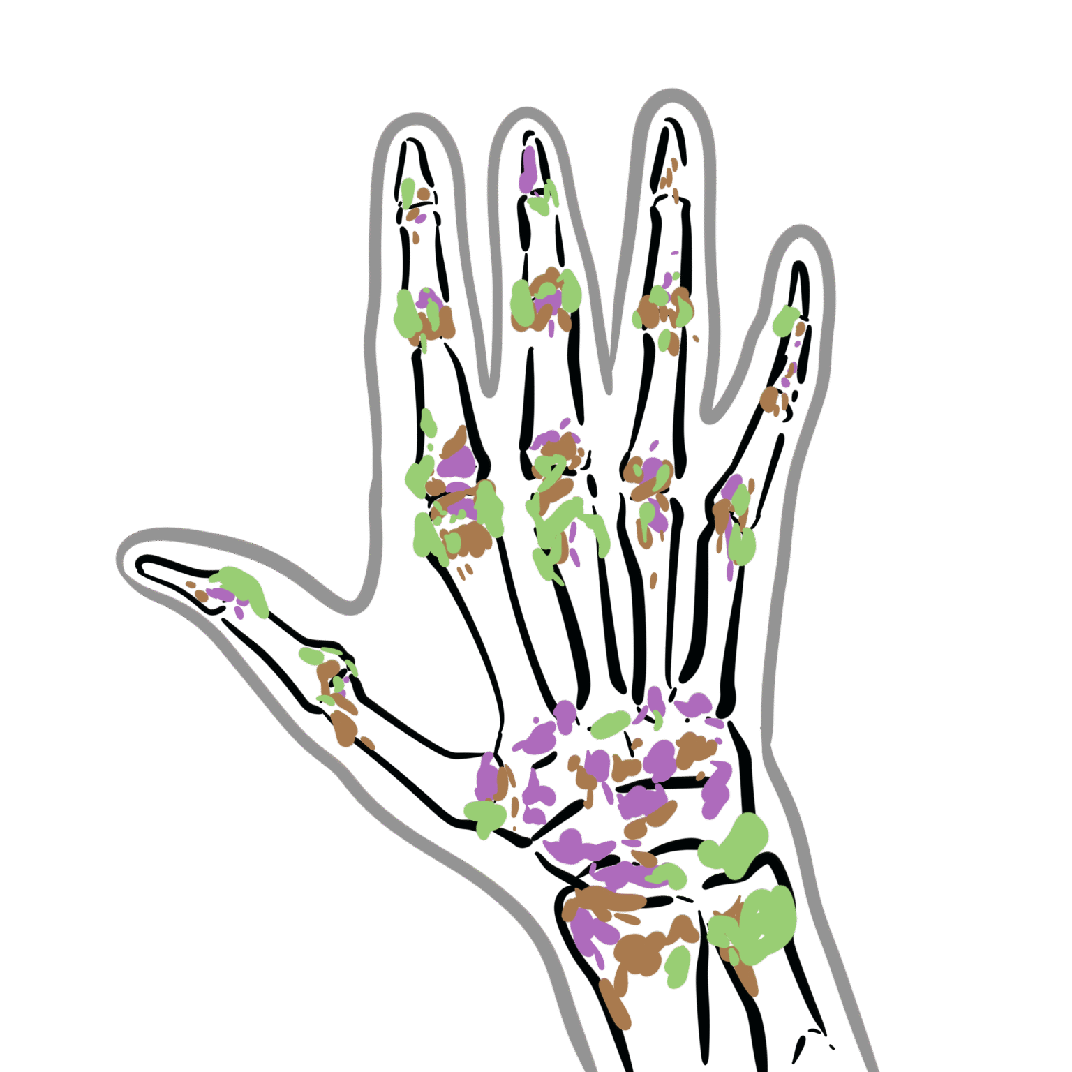 Caplan Syndrome - Armando Hasudungan