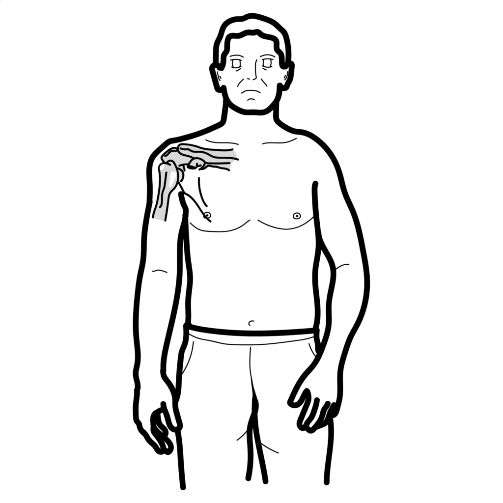 Basic Calcium Phosphate Disease / Milwaukee Shoulder Syndrome Armando ...