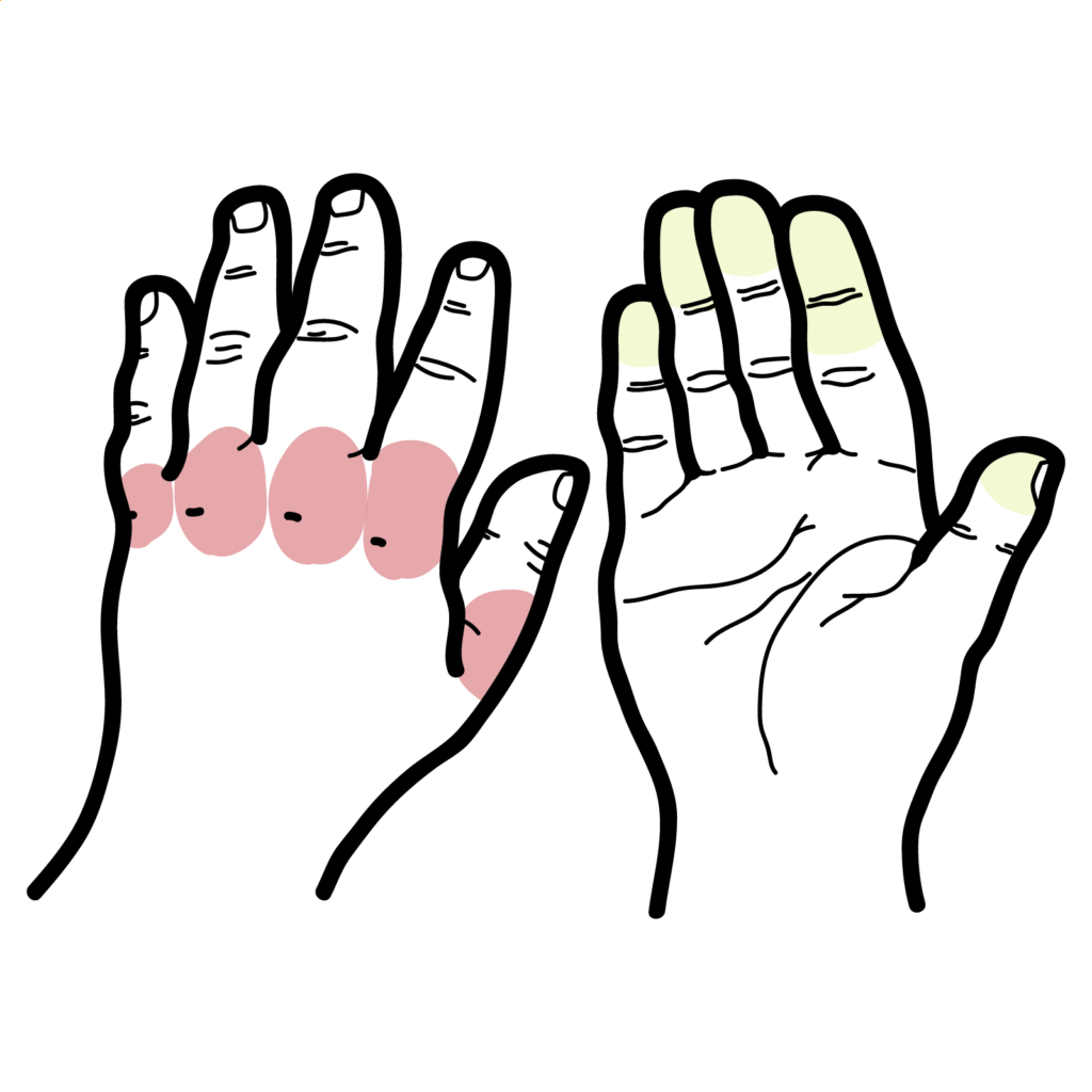 Undifferentiated Connective Tissue Disease (UCTD) - Armando Hasudungan