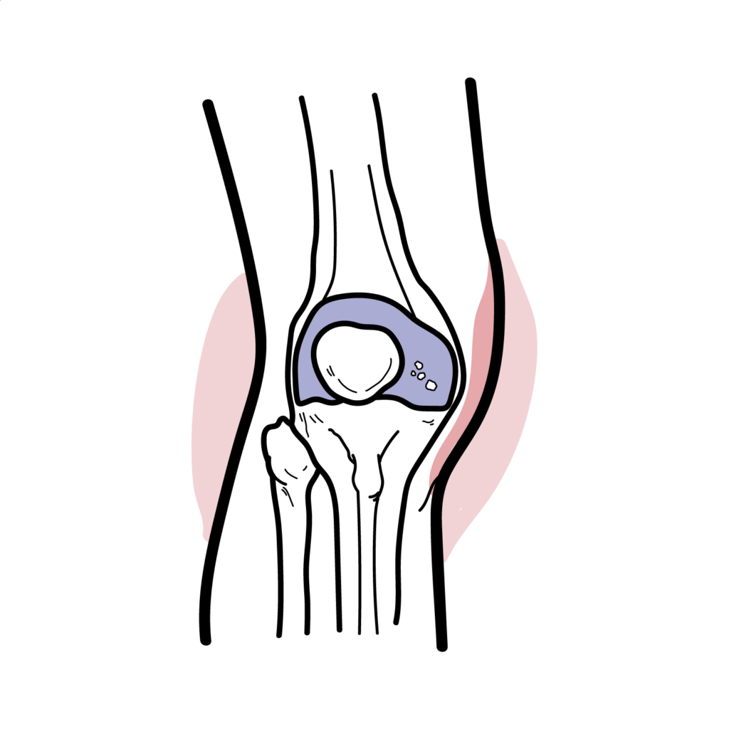 Undifferentiated Connective Tissue Disease (UCTD) Armando Hasudungan