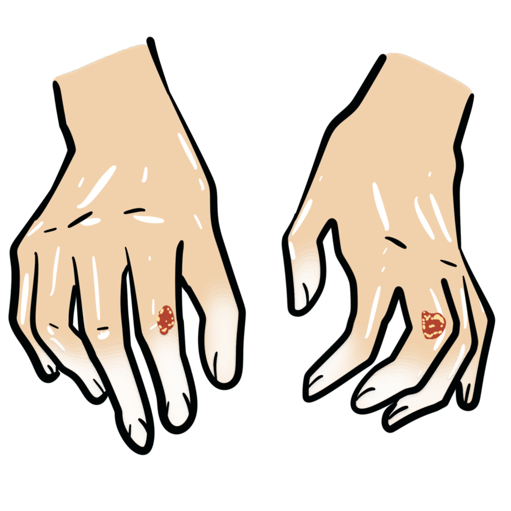 Systemic Sclerosis (SSc) - Armando Hasudungan