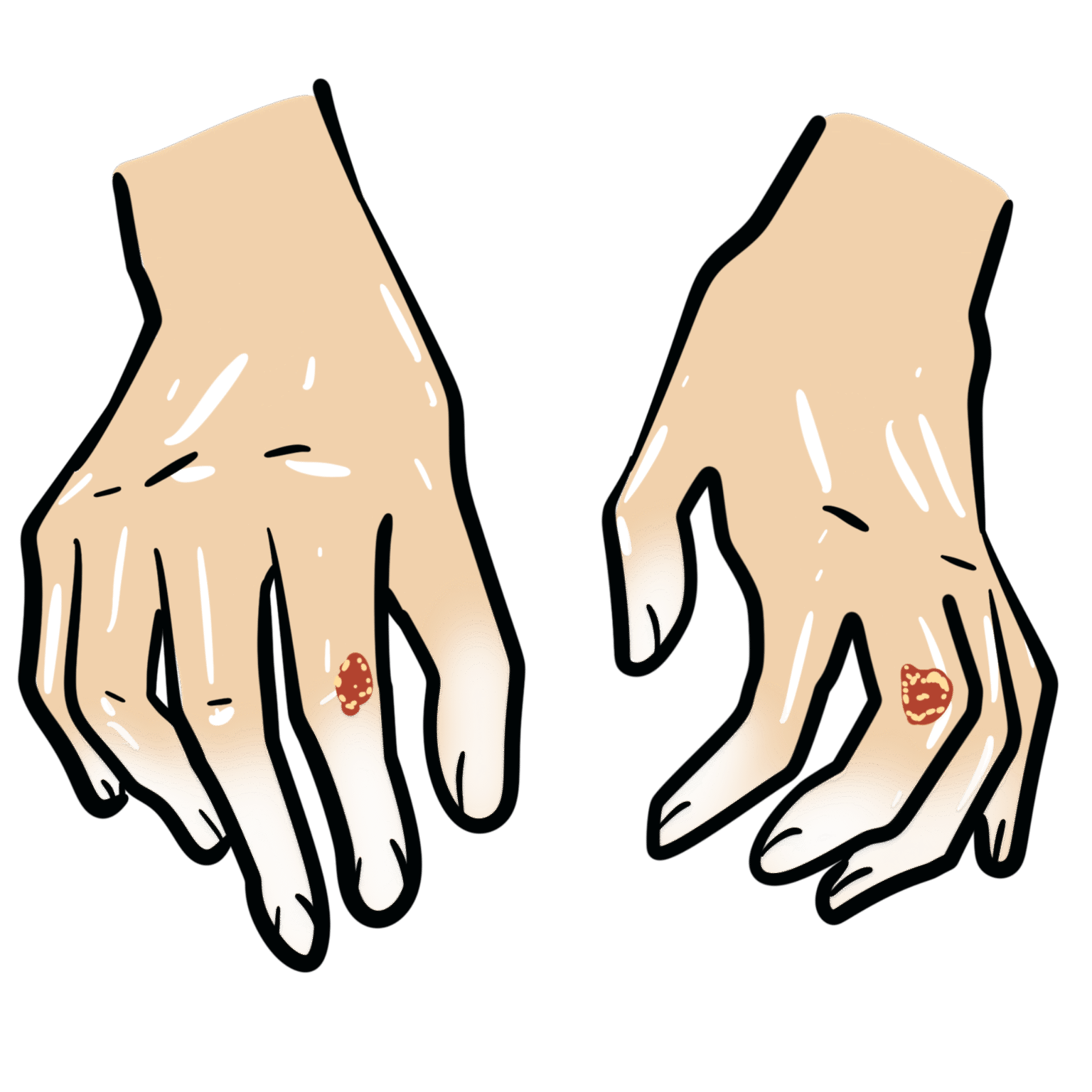Undifferentiated Connective Tissue Disease (UCTD) Armando Hasudungan
