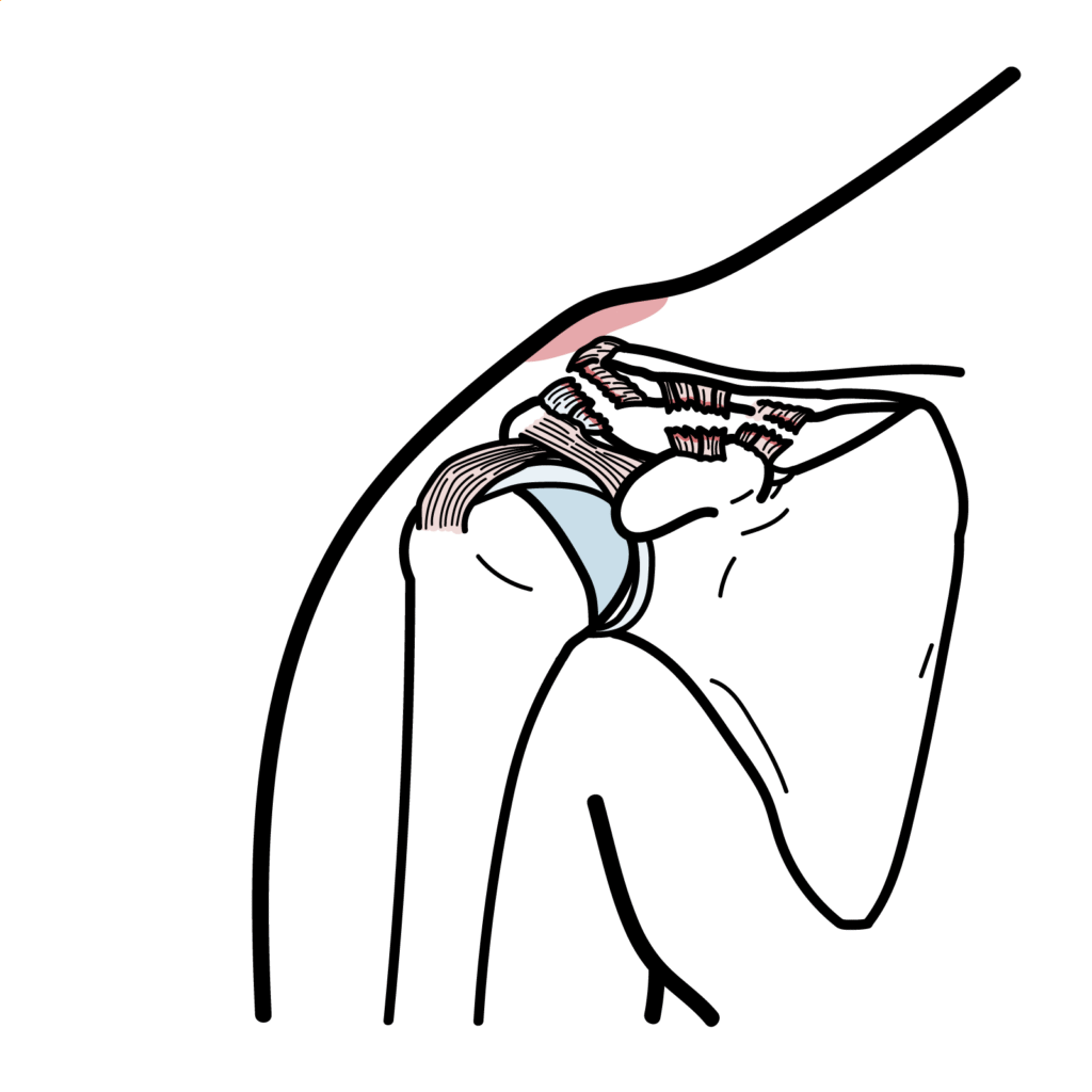 AC Joint Separation Armando Hasudungan