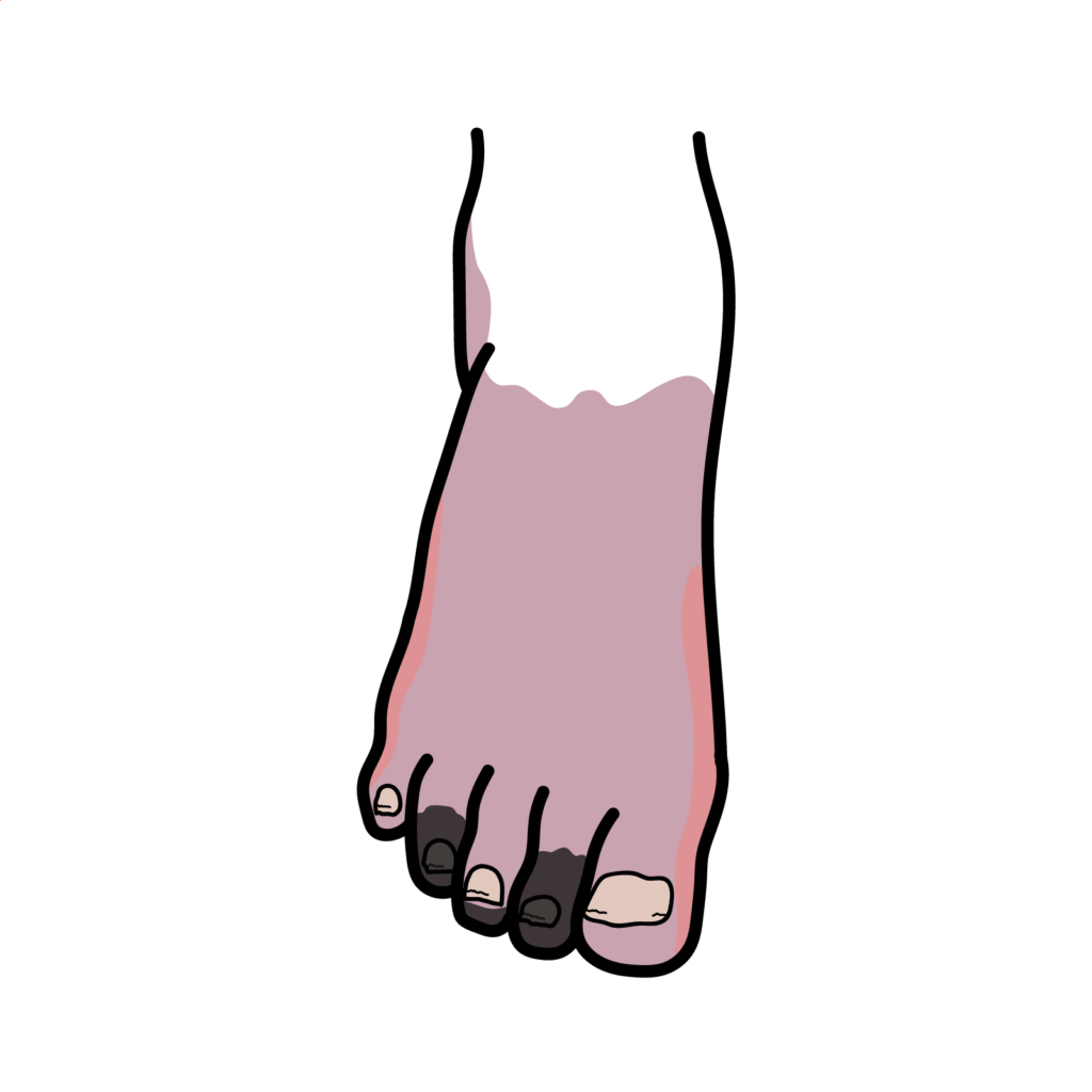 Chronic Lower Limb Ischaemia: Intermittent Claudication - Armando ...