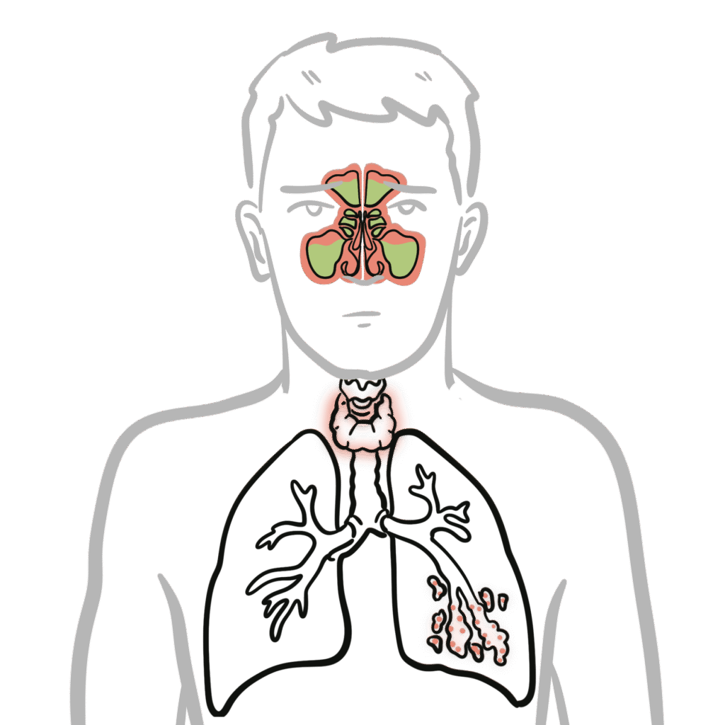 Hyper-IgE Syndrome (Job’s Syndrome) Armando Hasudungan