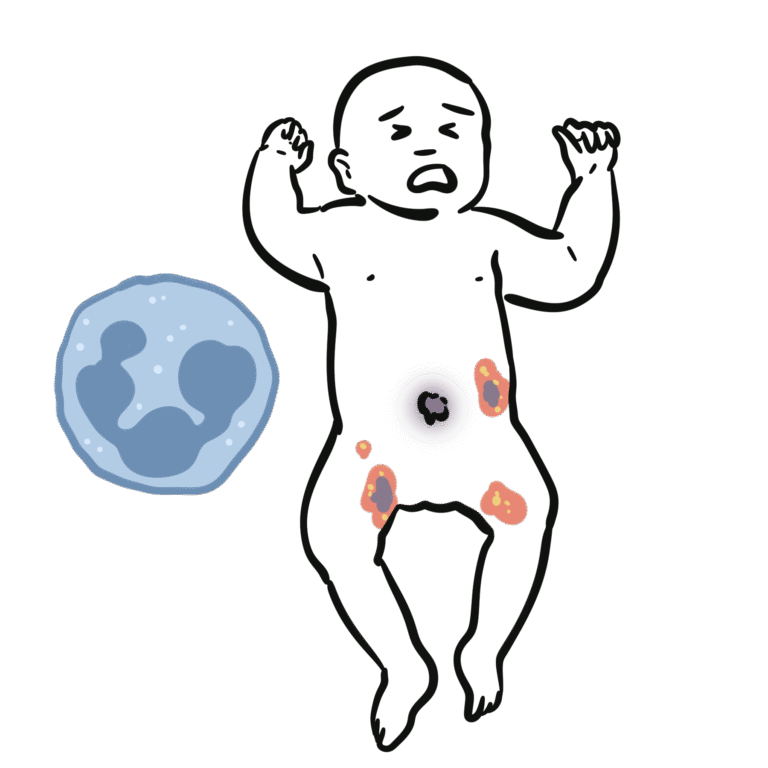 Hyper-IgE Syndrome (Job’s Syndrome) Armando Hasudungan