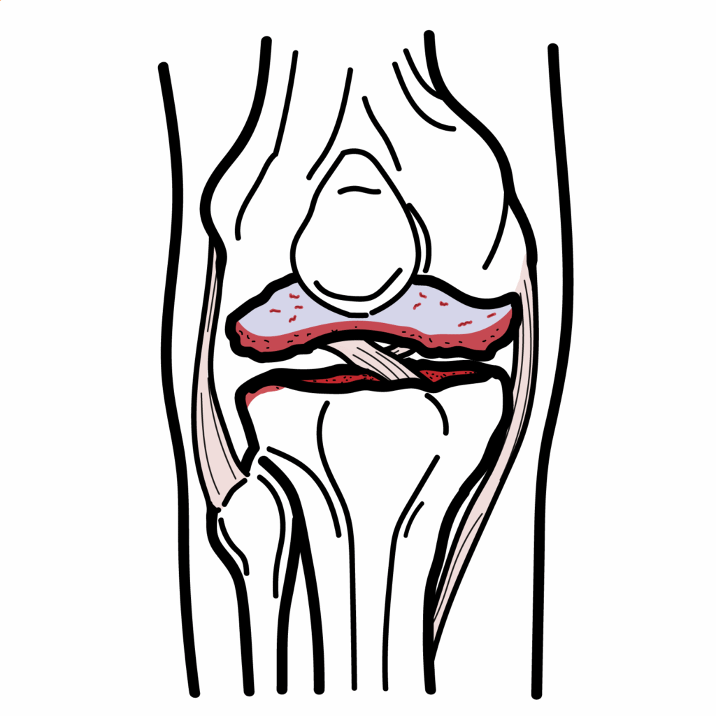 Undifferentiated Connective Tissue Disease (UCTD) Armando Hasudungan