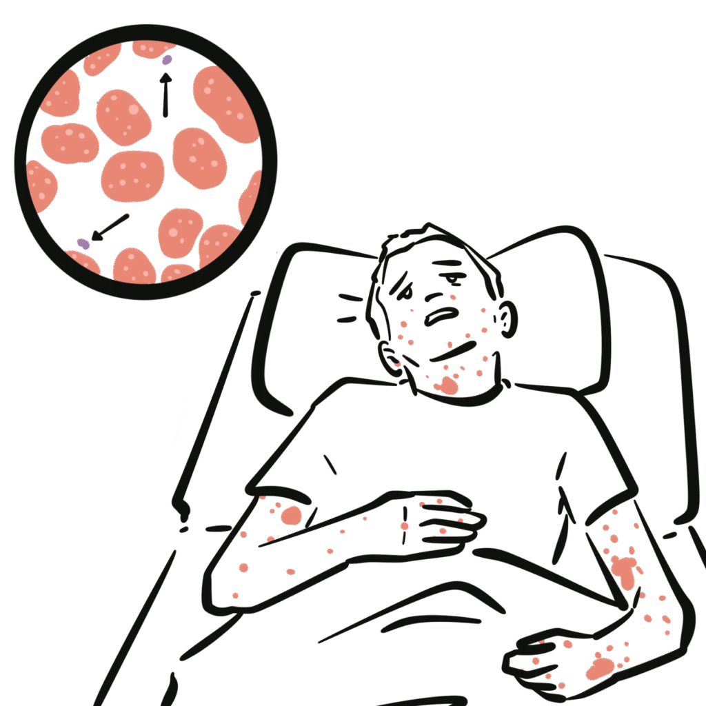 Hyper-IgE Syndrome (Job’s Syndrome) Armando Hasudungan