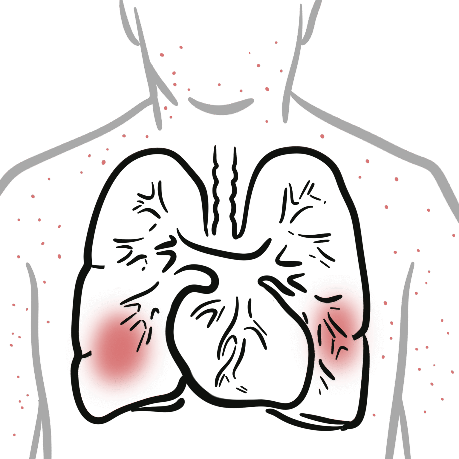 Caplan Syndrome Armando Hasudungan