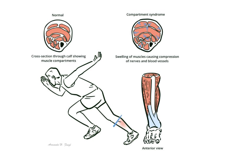 Chronic Exertional Compartment Syndrome (Exercise-induced Compartment ...