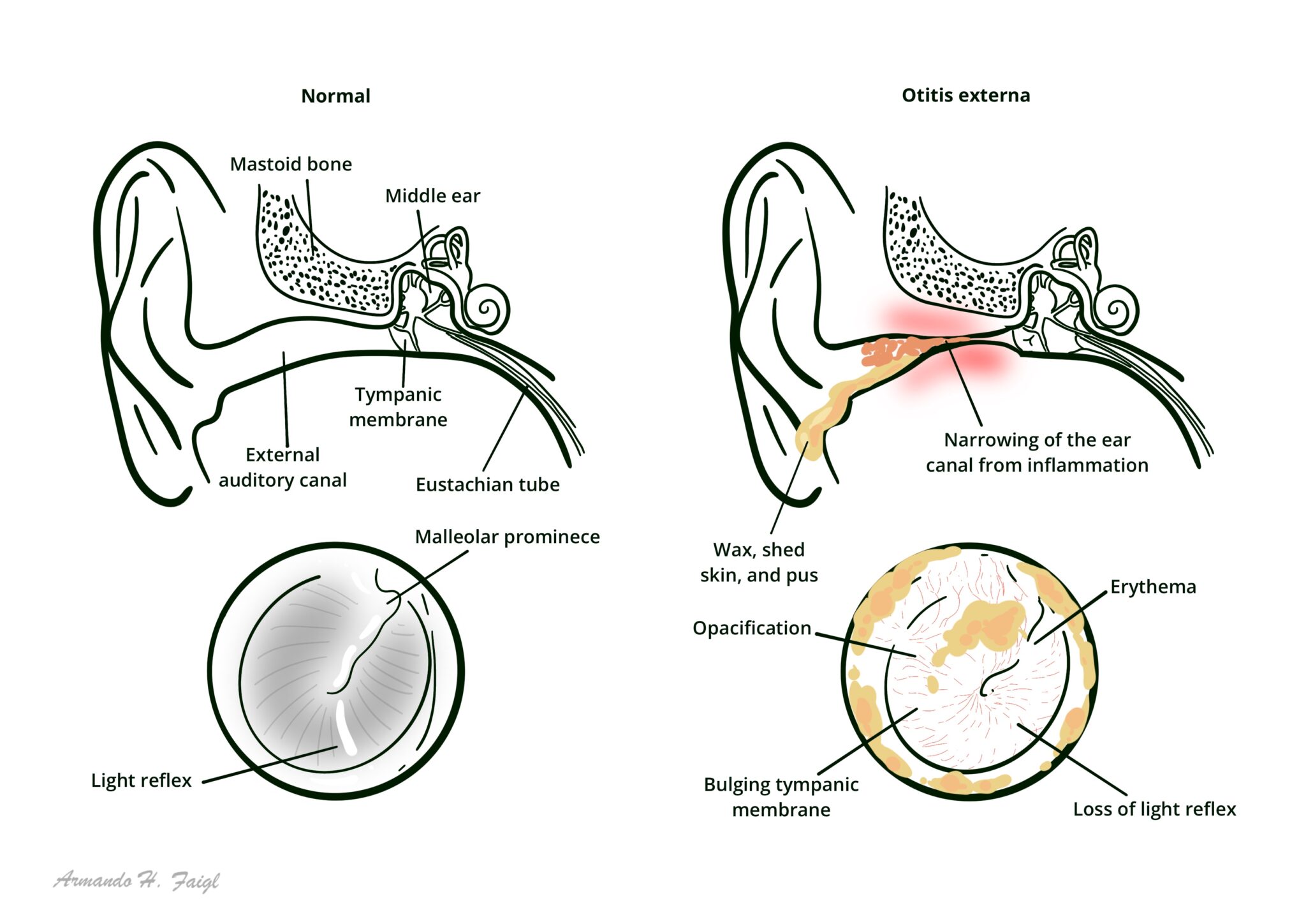 Otitis Externa Armando Hasudungan