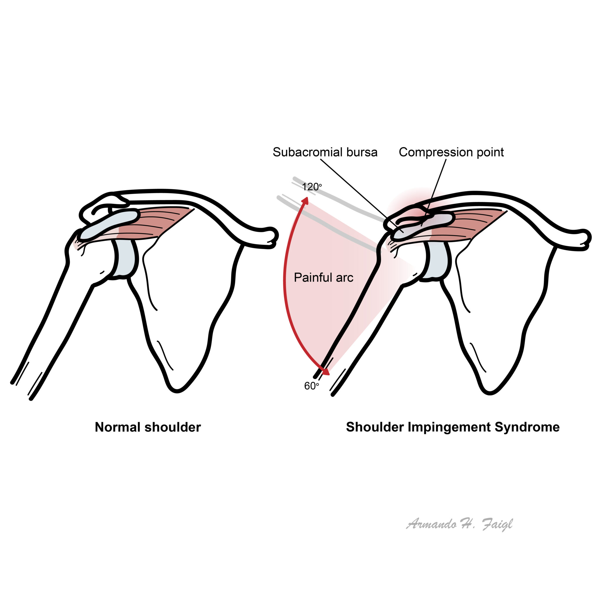 Shoulder Impingement Syndrome (Subacromial Pain Syndrome) Armando ...